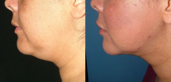 Fat Dissolving Injections - Symetrie