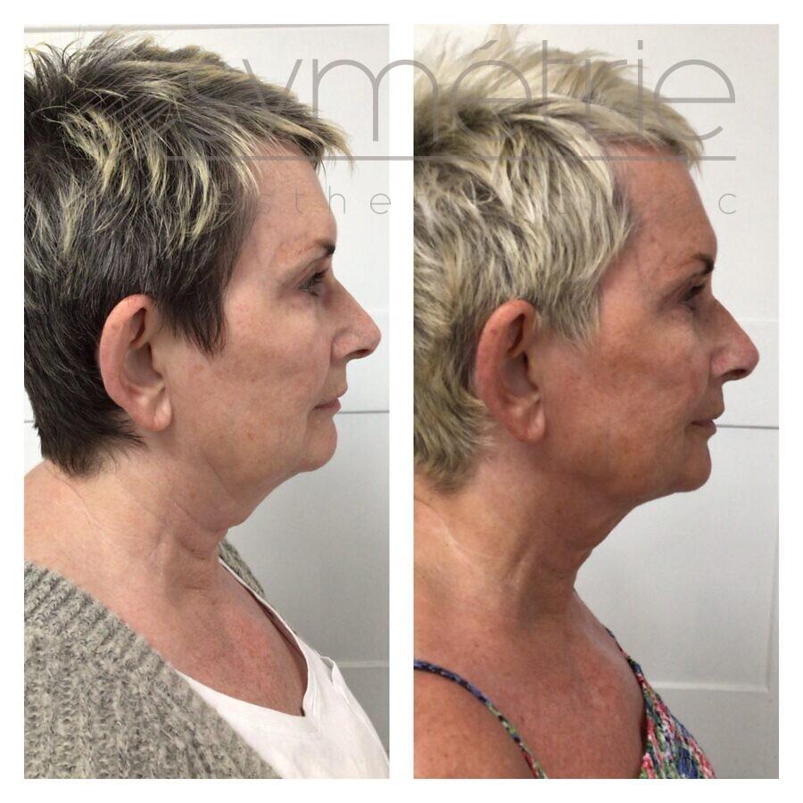 Celluform (Fat Dissolving) - Symetrie